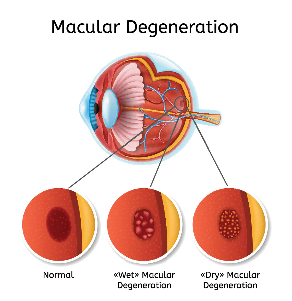 Retinal Diseases - Retina Consultants of New Orleans